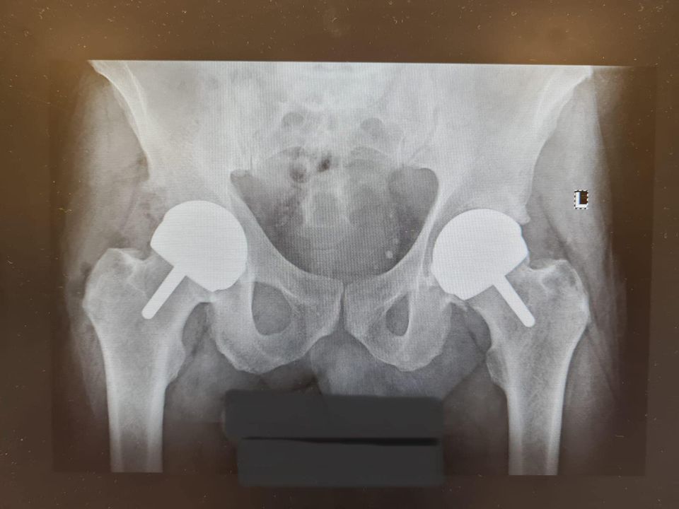 Exploring Hip Resurfacing Devices: A Guide for Informed Decisions - Hip ...