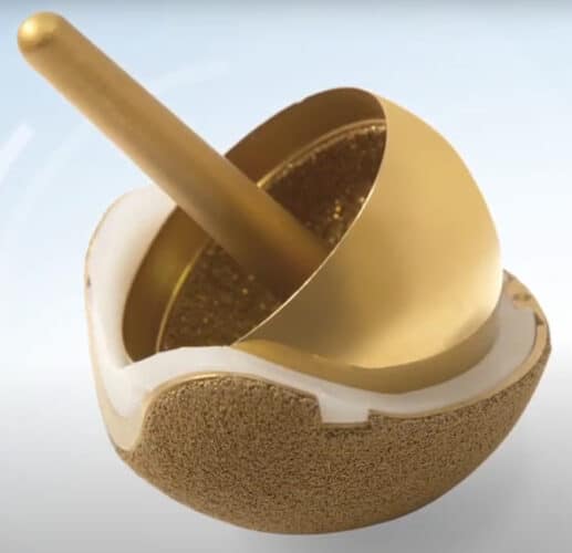 Exploring Hip Resurfacing Devices: A Guide for Informed Decisions - Hip ...